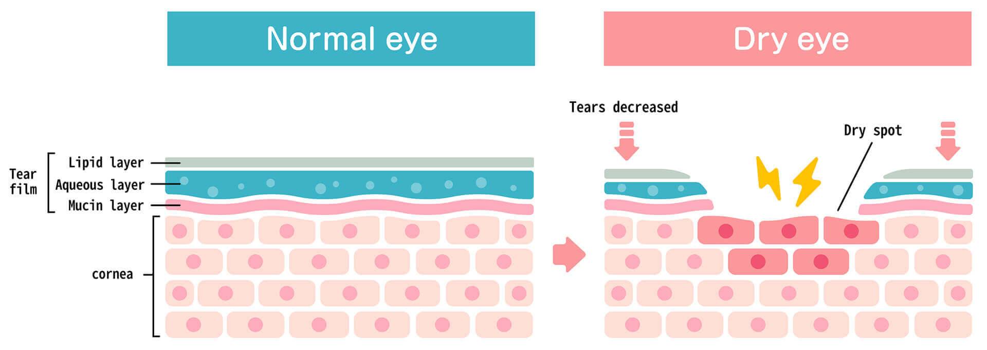Evaporative Dry Eye Disease at James Aviles blog